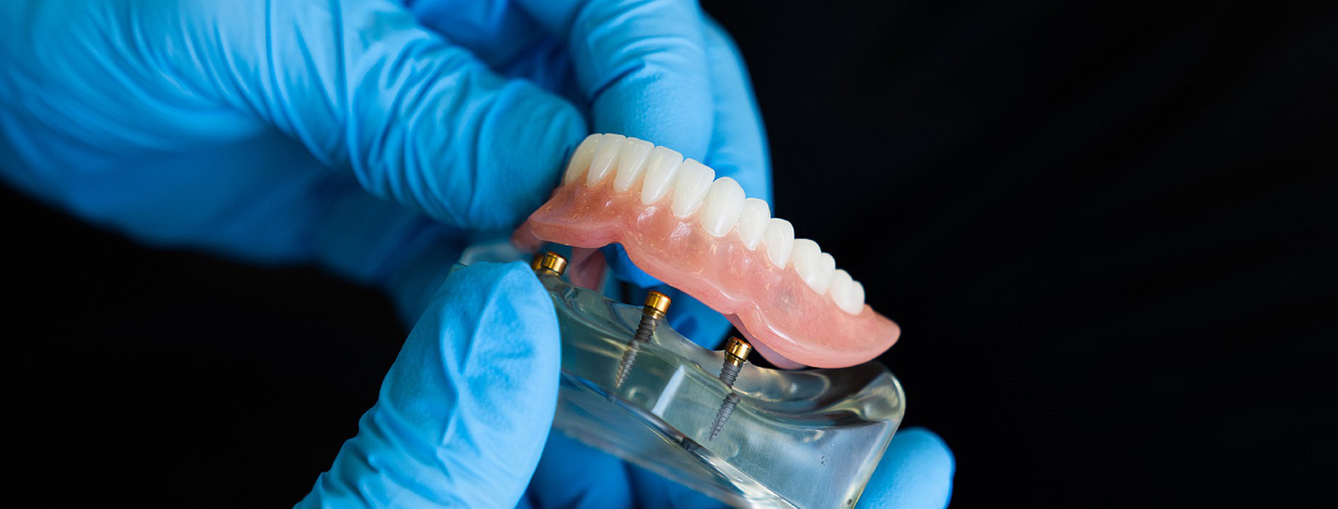 Feste Zähne an einem Tag